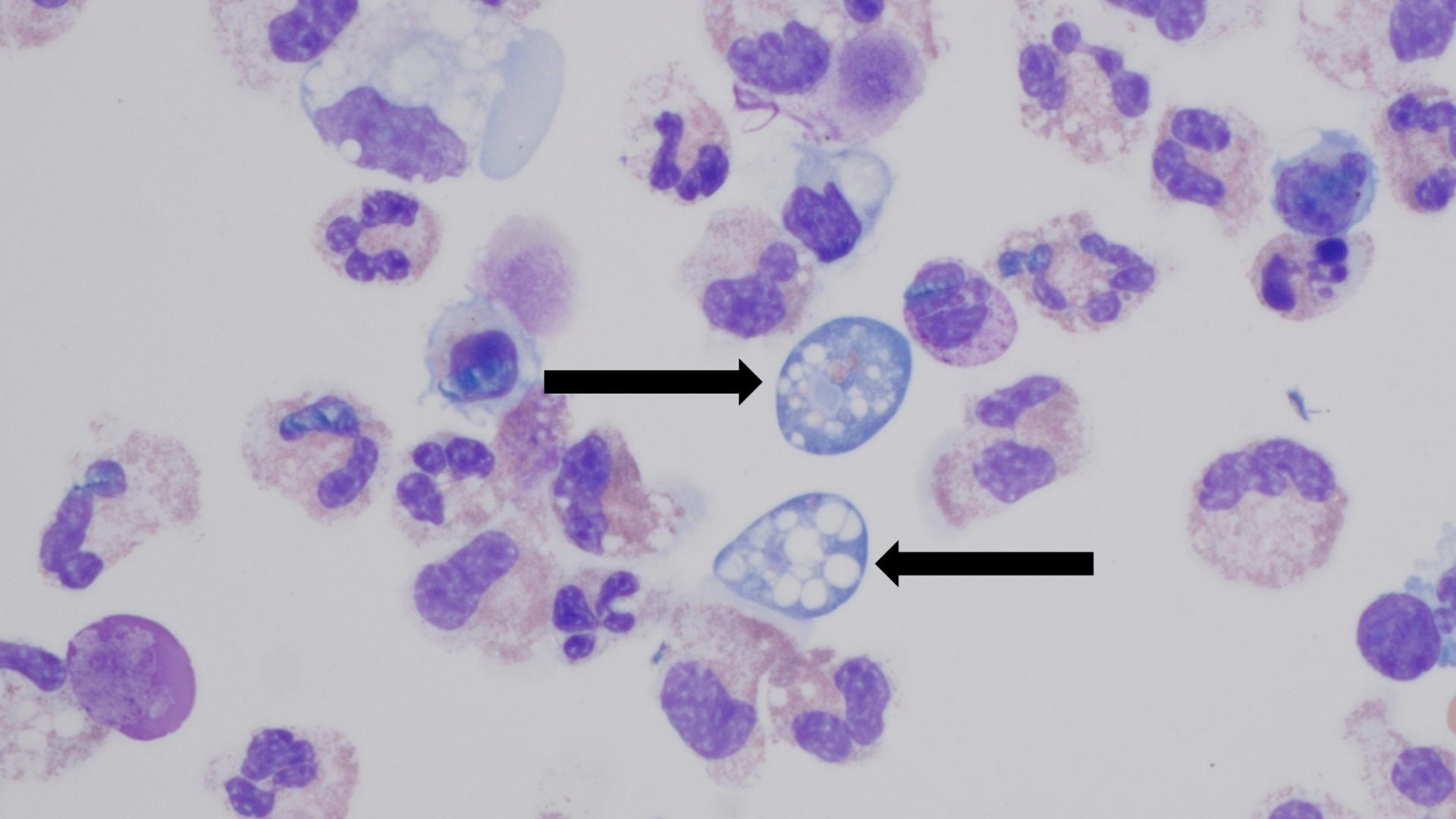 Brain-eating amoeba infection: What to know after Missouri case ...