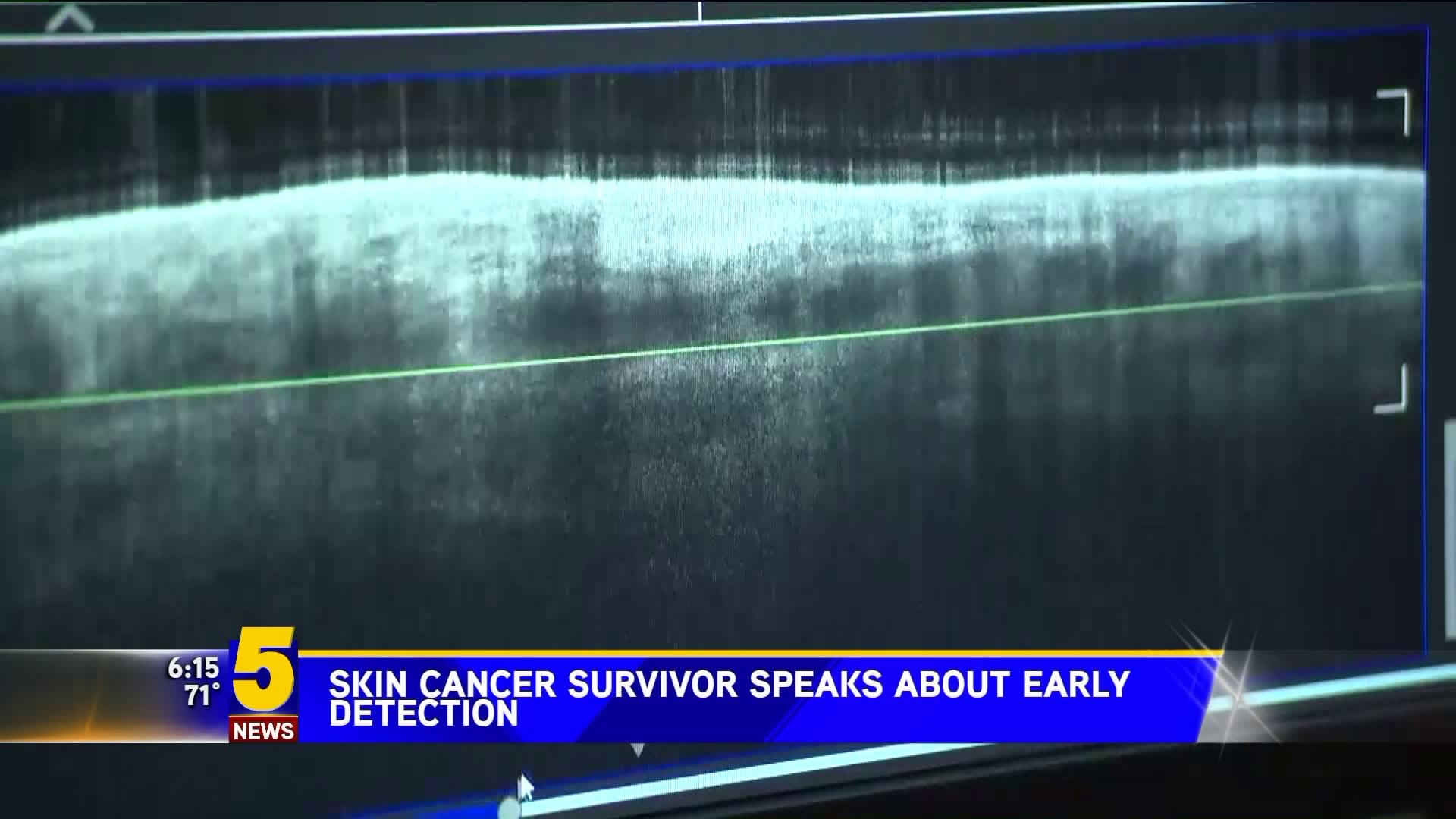 Skin Cancer Awareness Month: A Melanoma Survivor’s Tale | 5newsonline.com
