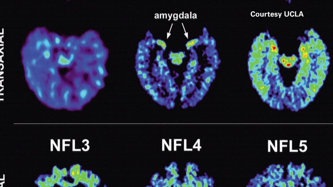 NFL Acknowledges CTE Link With Football. Now What? | 5newsonline.com
