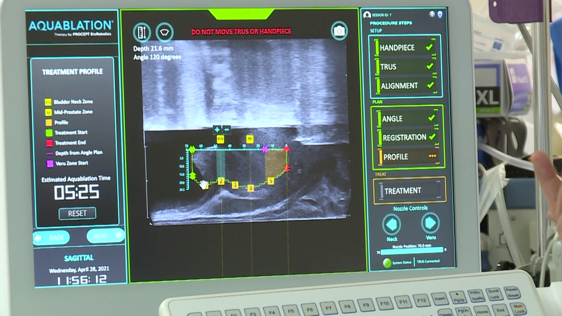 Healthy Living: Aquablation Therapy Now Available at Baptist Health ...