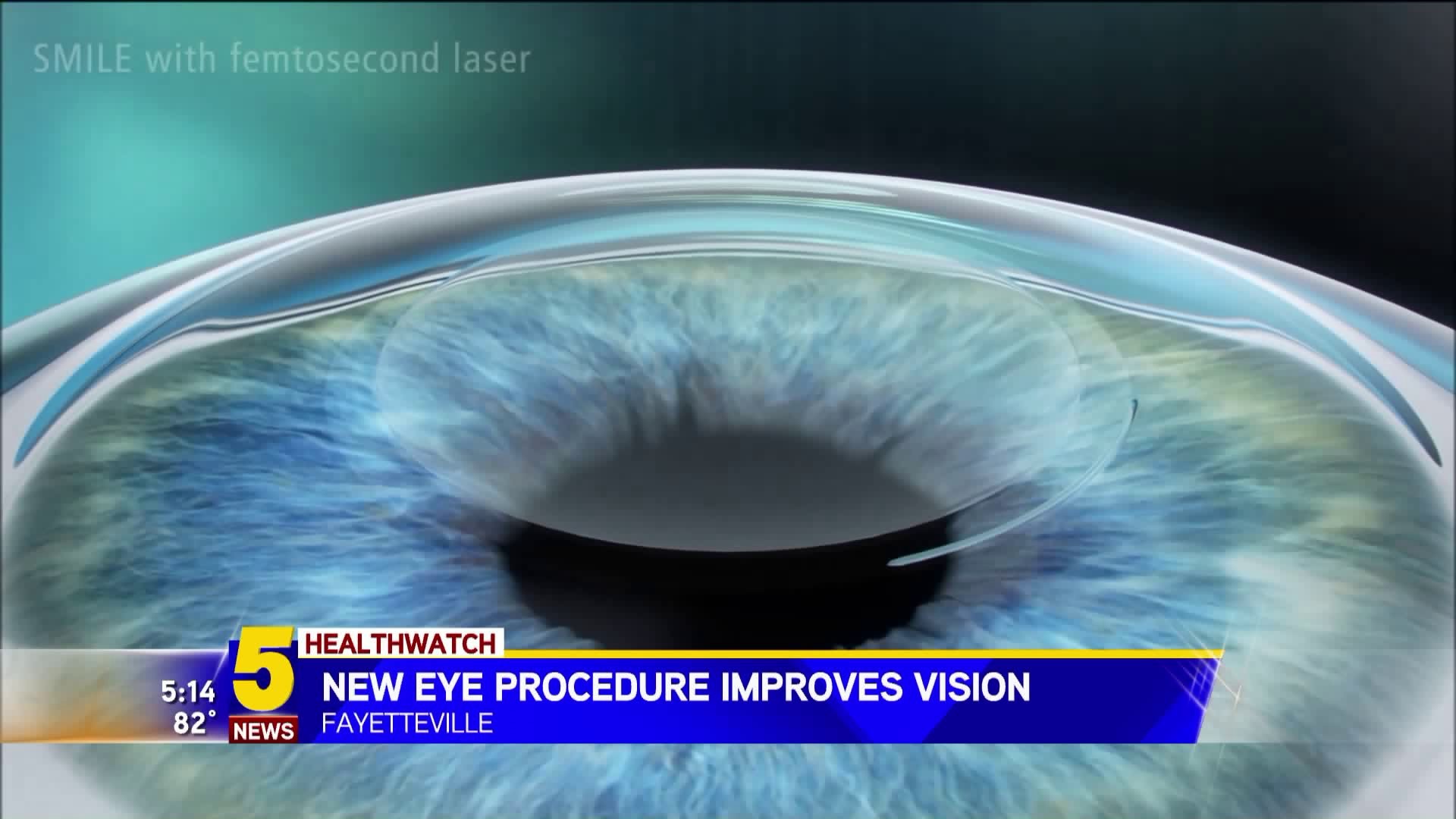 New Procedure To Correct Vision Is Now Available In Northwest Arkansas ...
