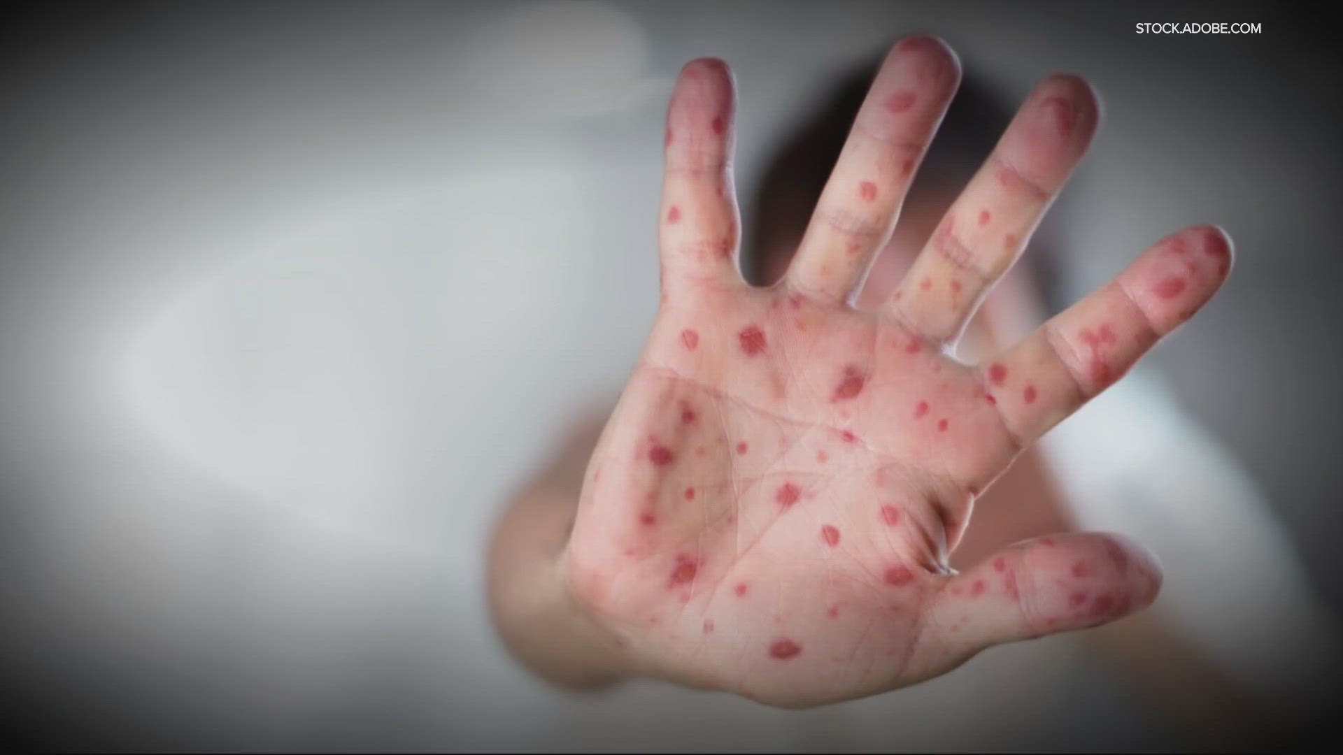 South Carolina health officials say largest measles outbreak in the US ...