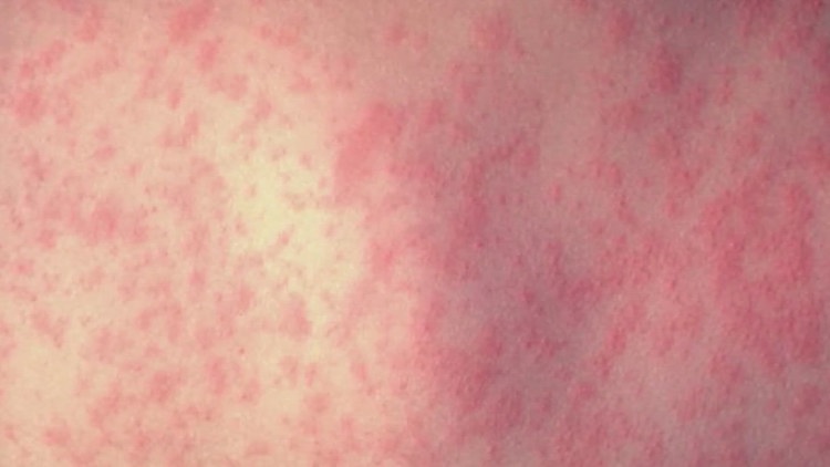 First measles case of 2026 confirmed in Maricopa County - World Online