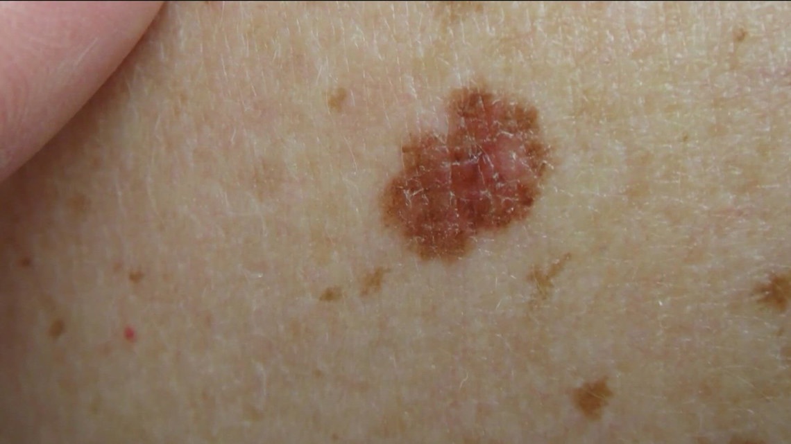 Study shows personalized mRNA vaccine cuts melanoma recurrence risk in ...