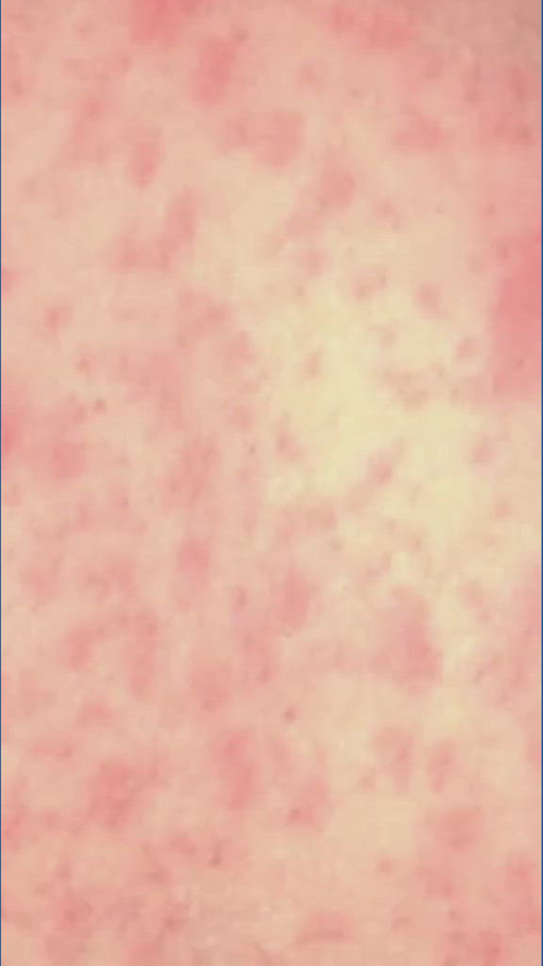 Iowa's measles vaccination rate below what's needed to stop spread ...