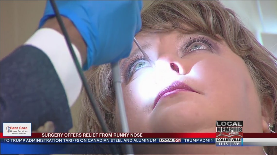 Local Health Alert: How A Runny Nose Could Lead To Surgery ...