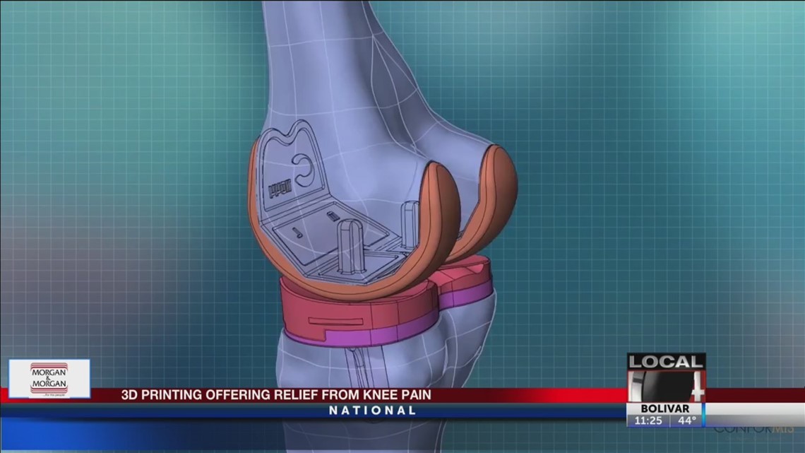 Local Health Alert: 3D Printing Helps Treat Knee Pain | localmemphis.com