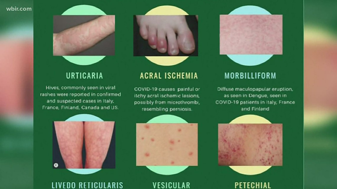Doctor: skin rash could be a symptom as possible COVID-19 symptom ...