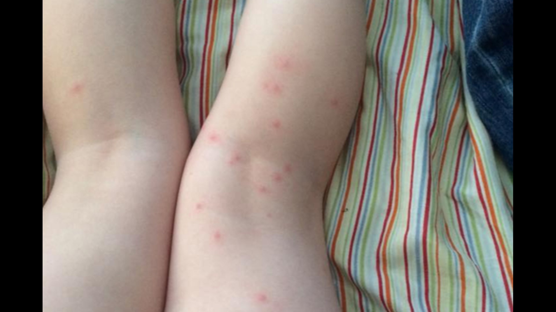 Mom shares terrifying photos of 3-year-old covered in "seed ticks ...