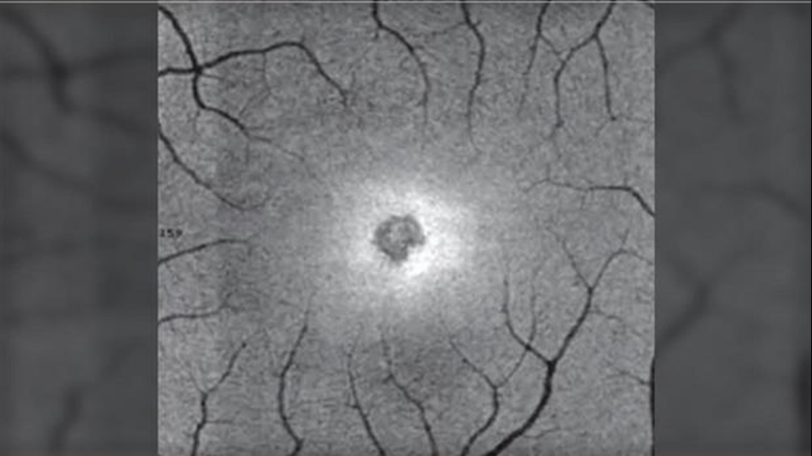 Solar eclipse damage to woman's eye revealed in striking images | 10tv.com