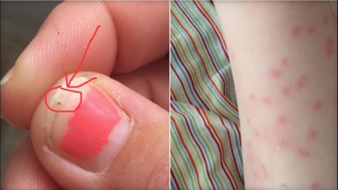 Mom shares terrifying photos of 3-year-old covered in "seed ticks ...