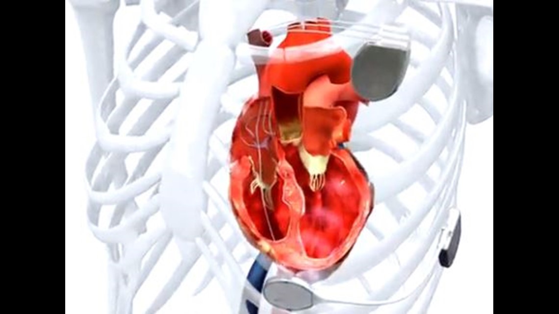 "Wireless" pacemaker brings new hope for heart failure patients | 10tv.com