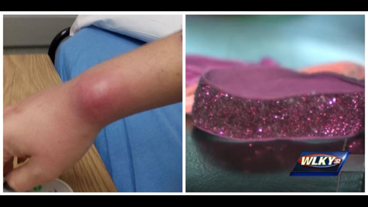 Woman Gets Life-Threatening Infection From Hair Tie Around Wrist | 10tv.com