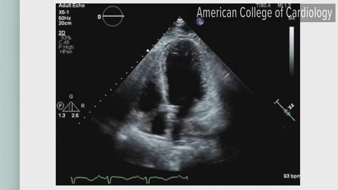 Hospitals see spike in 'Broken Heart Syndrome' cases | 10tv.com
