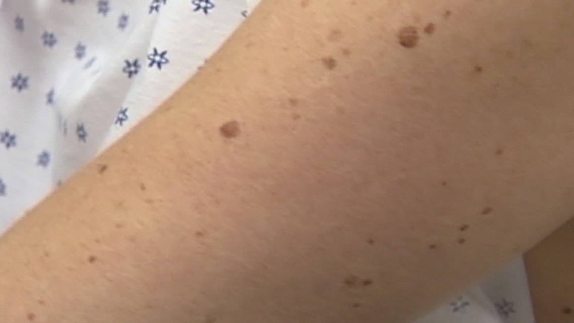 Iowa doctor shares skin cancer awareness tips as summer approaches ...