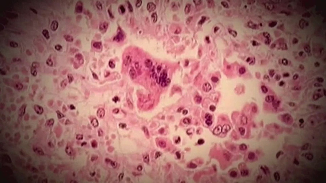 Iowa reports first measles case since 2019 | weareiowa.com