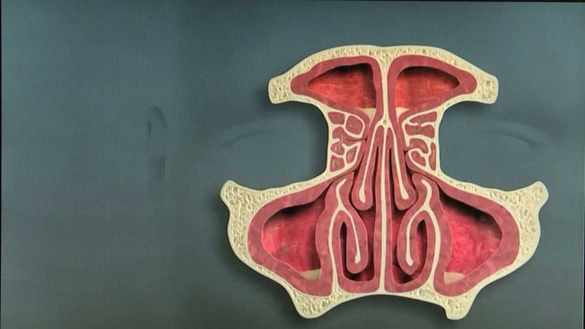 Easing Chronic Sinusitis | wnep.com