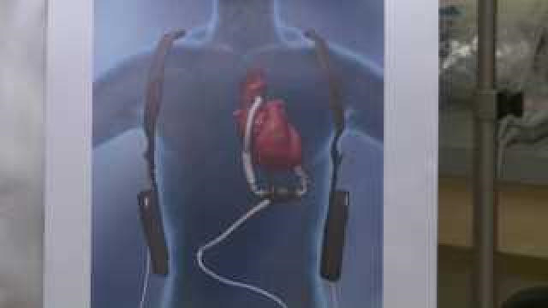New Heart Pump | wnep.com