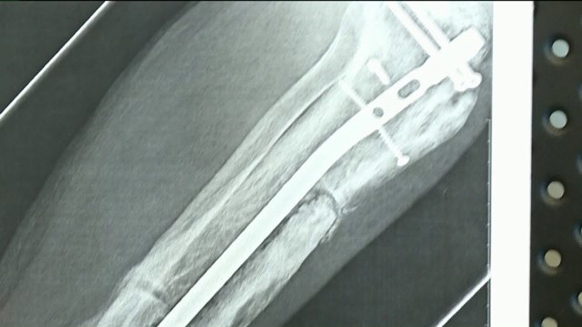 Healthwatch 16: New Surgery to Fix Bent Leg Bone | wnep.com