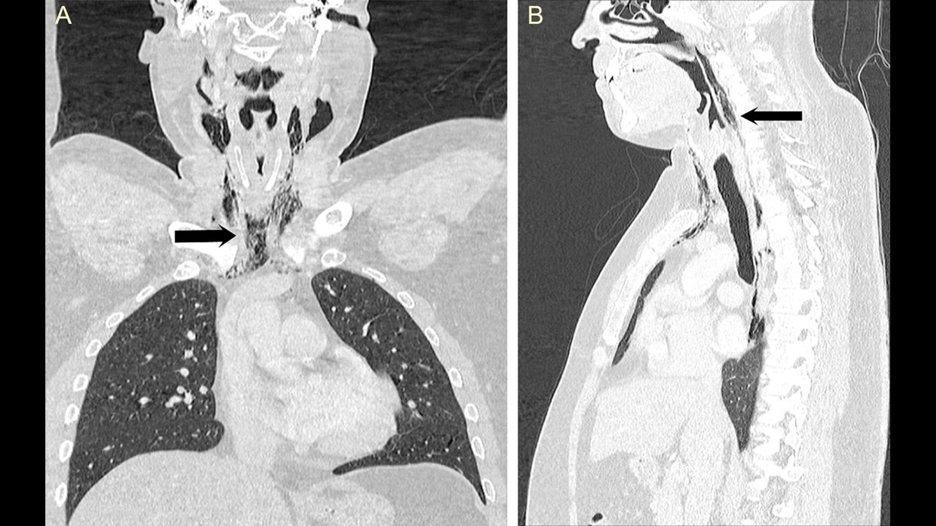 Man’s Attempt to Hold in Sneeze Leaves Him With Ruptured Throat | wnep.com