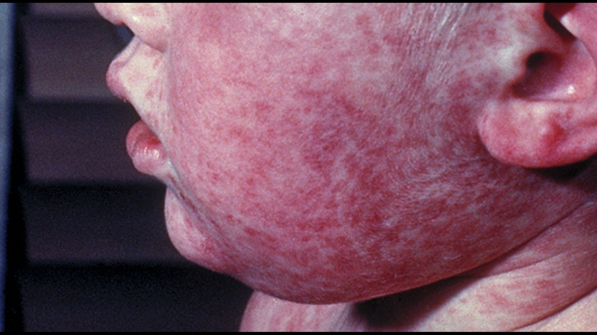 CDC Monitoring Spread of Measles After 107 Cases Reported in 21 States ...