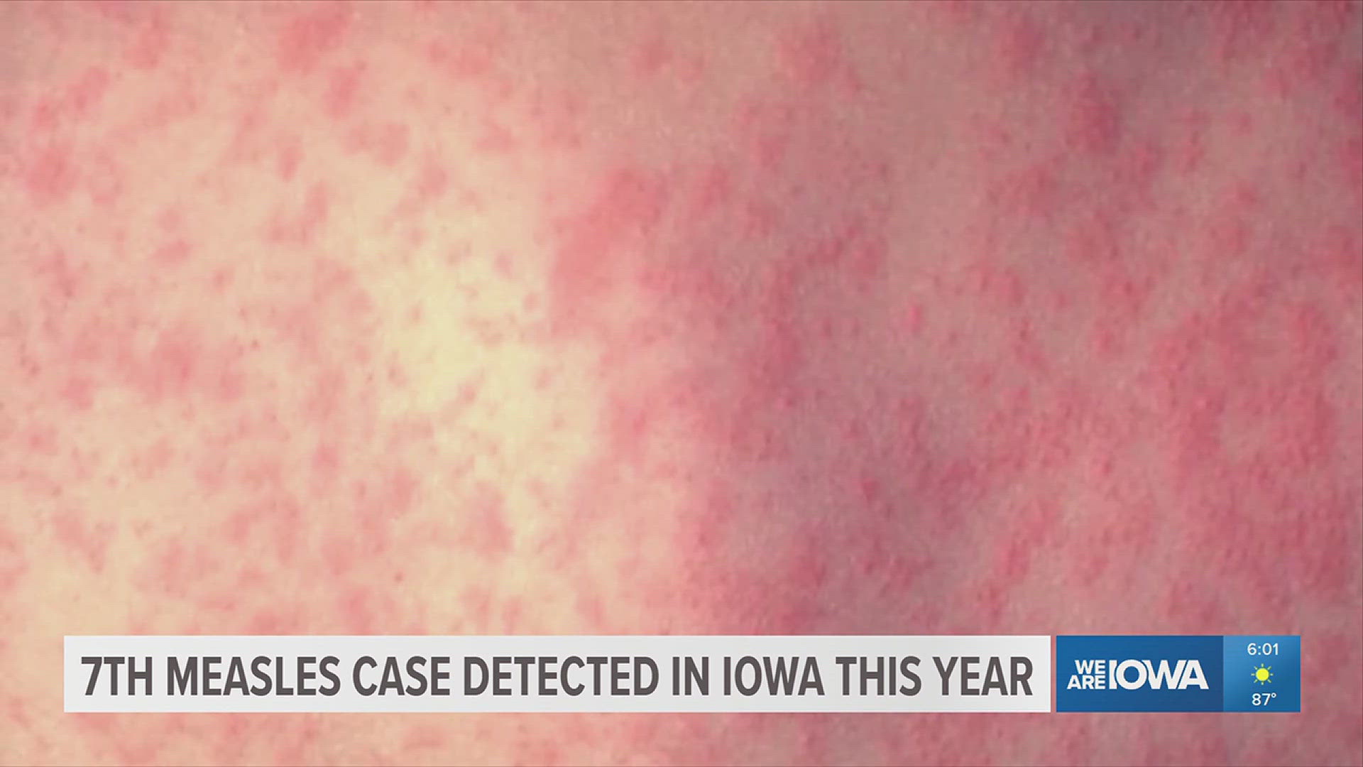 New measles case confirmed in eastern Iowa, 7th case of 2025 ...