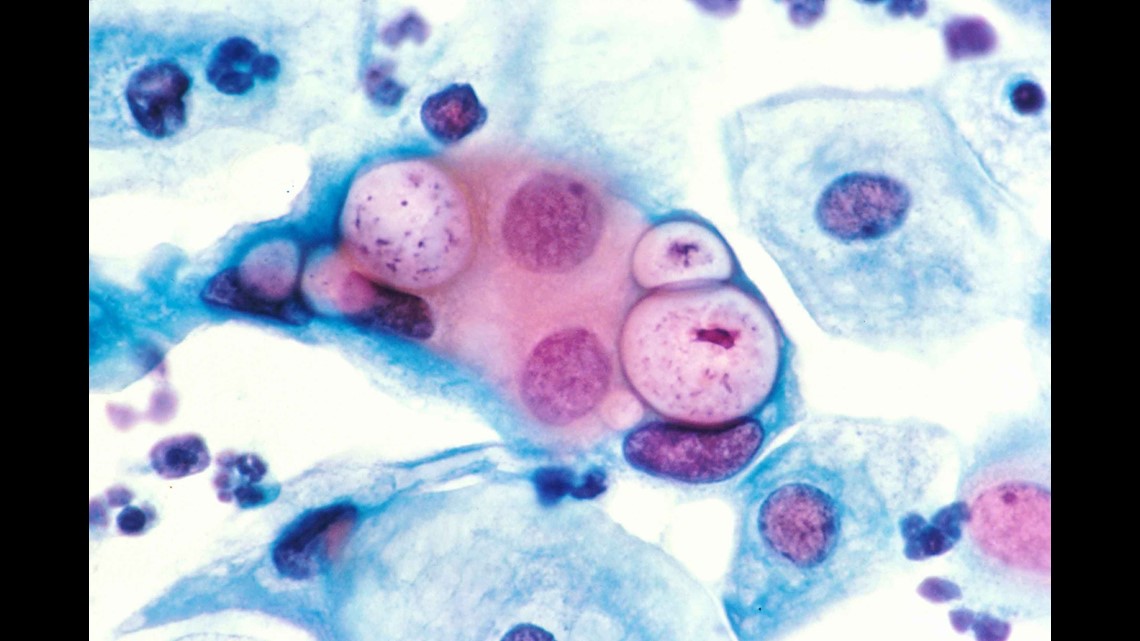 Survey: Baltimore has the highest rate of STDs in the country | fox43.com