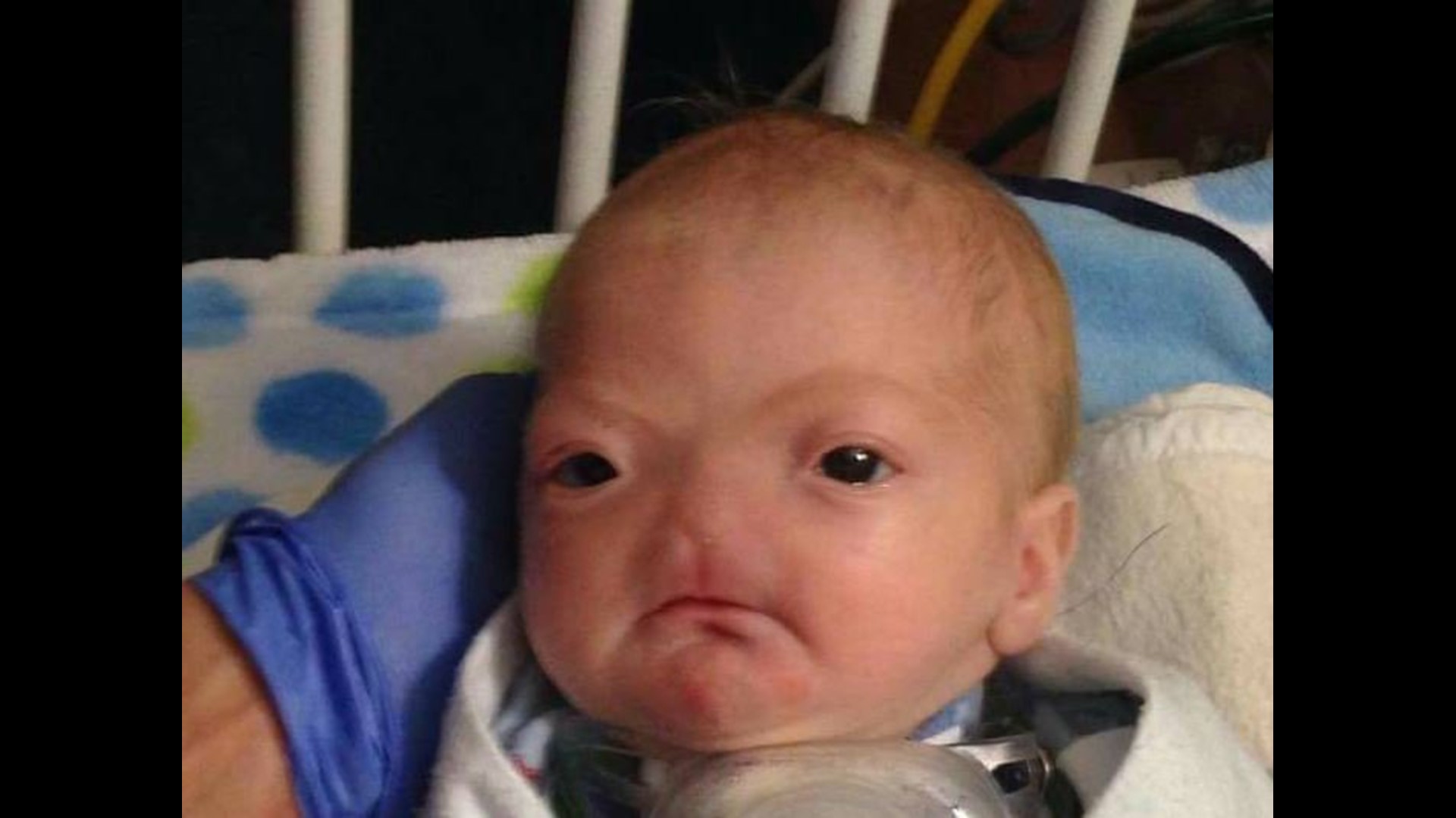 Meet Eli, the ‘Miracle Baby’ born without a nose | fox43.com