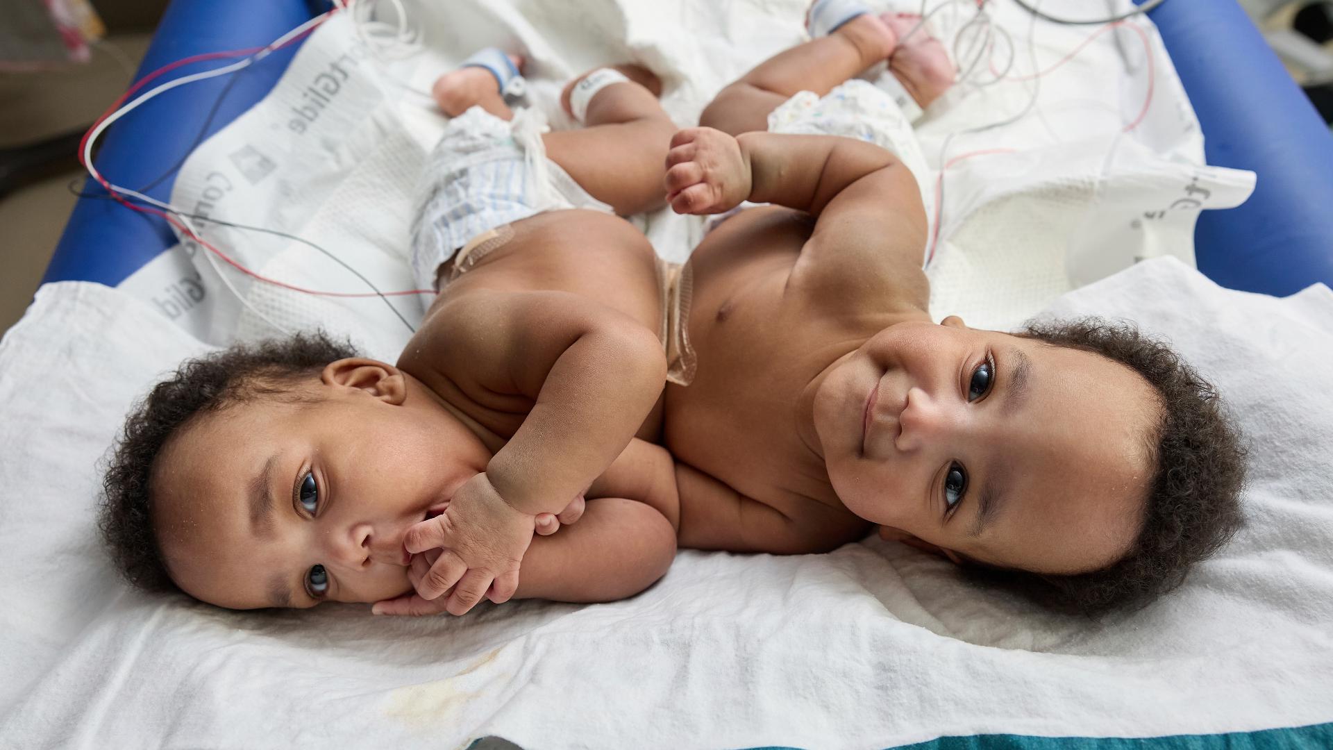 Twins born conjoined celebrate birthday after separation surgery | 10tv.com