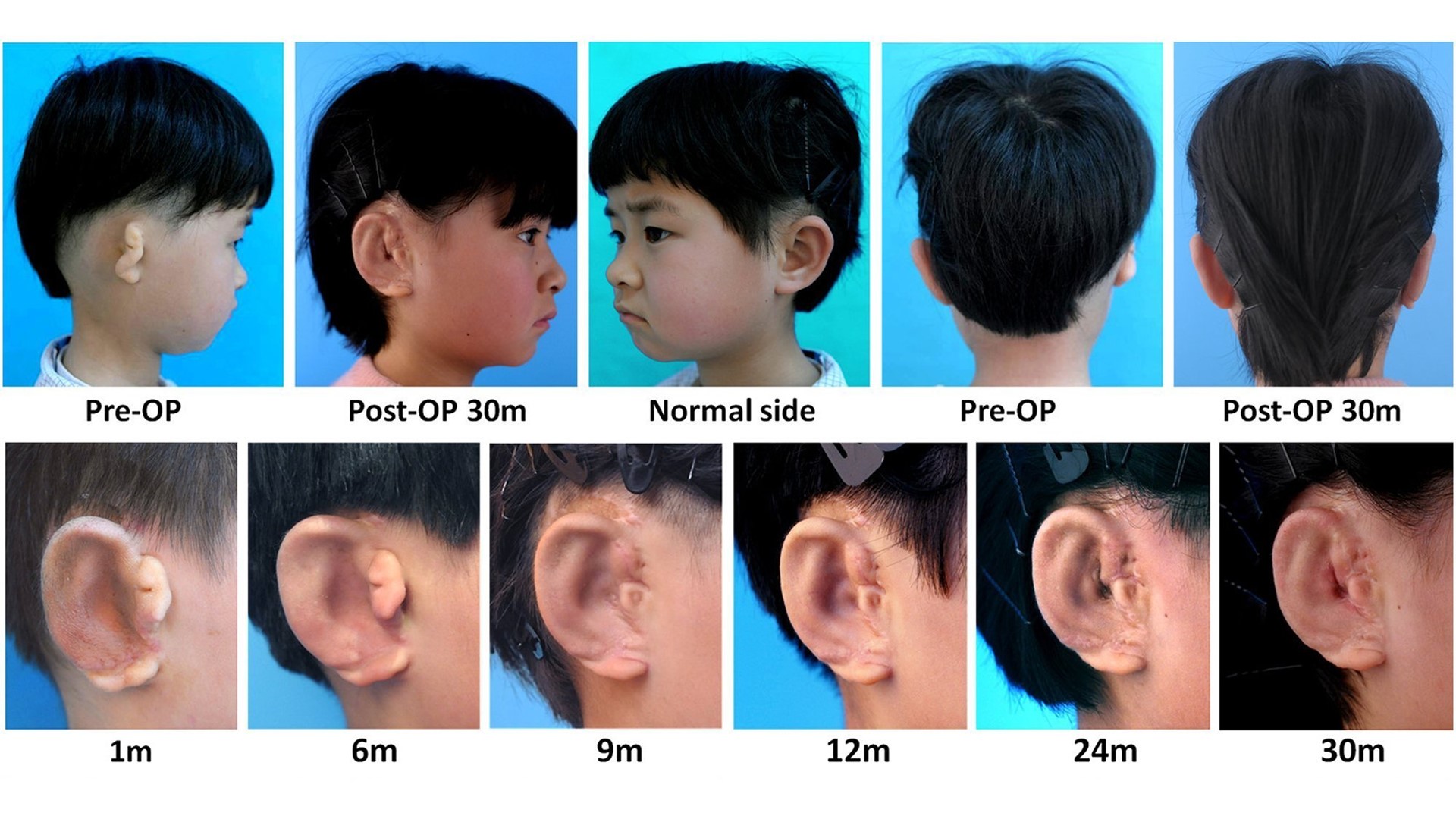 Scientists grow new ears for children with defect | fox43.com