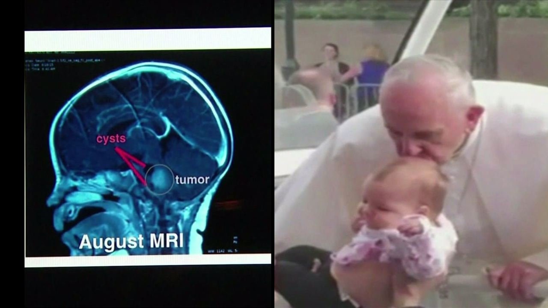 Parents say baby’s inoperable brain tumor shrunk after Pope’s kiss in ...