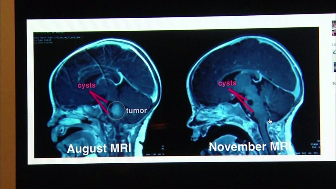 Parents say baby’s inoperable brain tumor shrunk after Pope’s kiss in ...