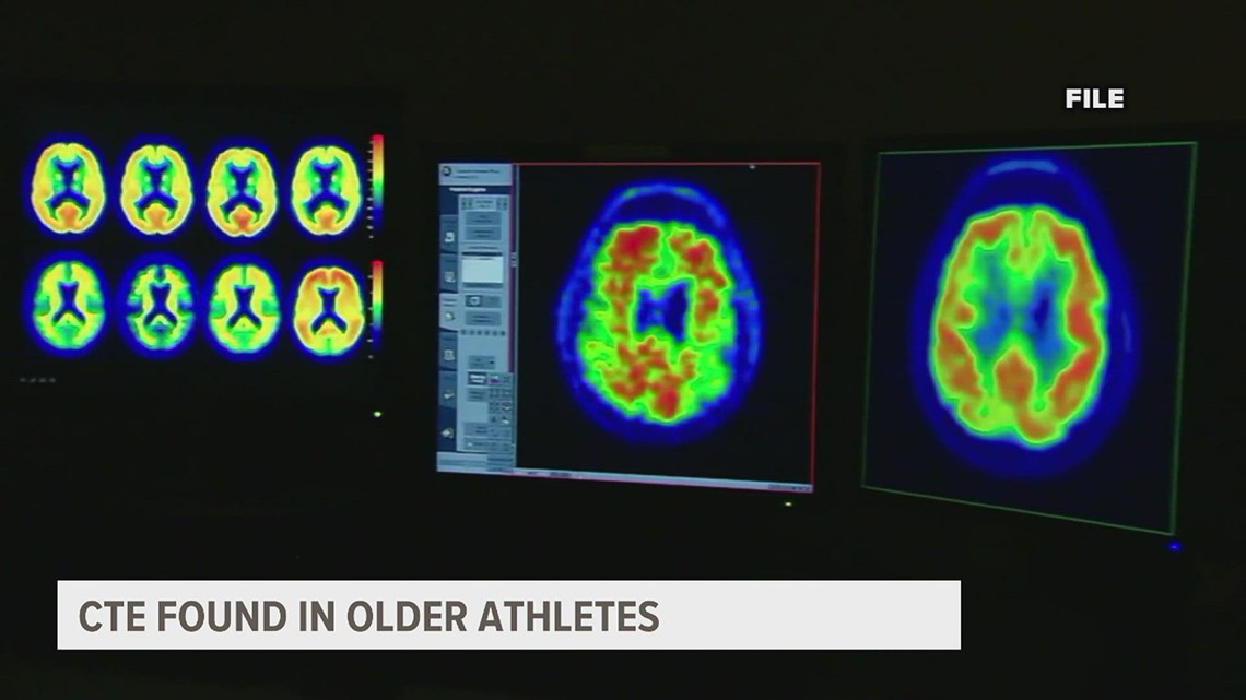 Cases of CTE rising in young athletes, causing memory loss and ...