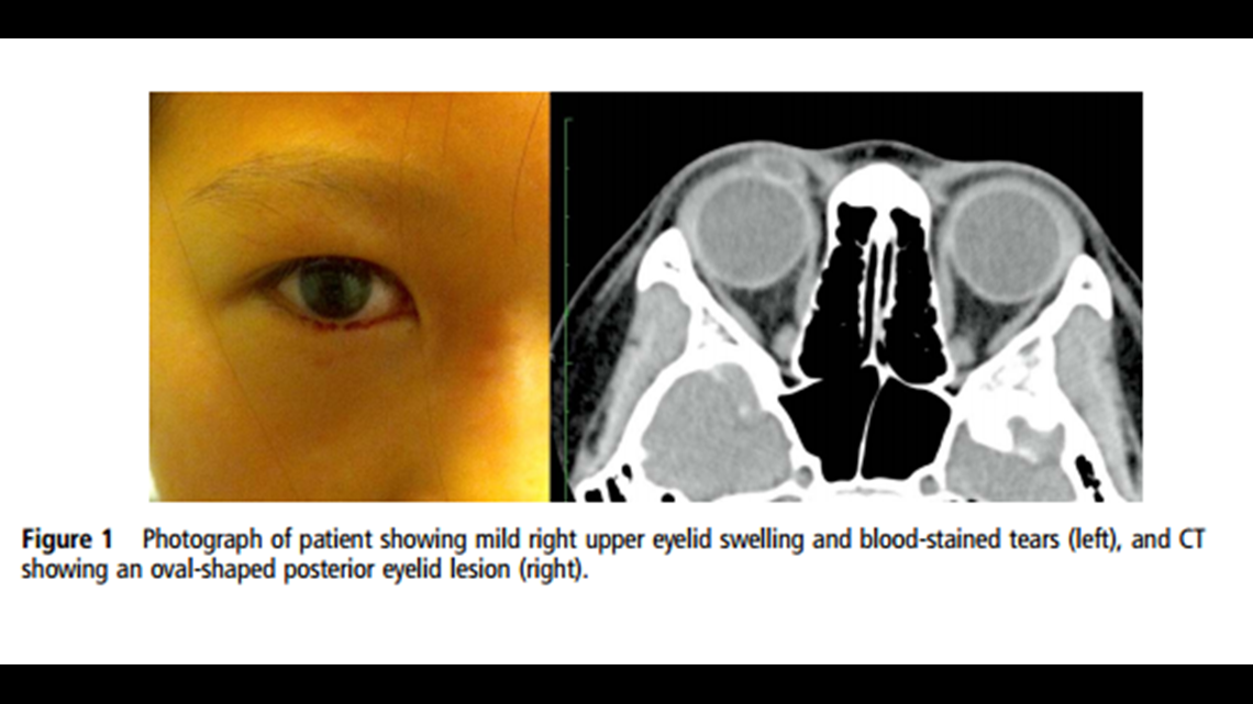Child’s swollen eye, bloody tears caused by contact lens stuck for 2 ...