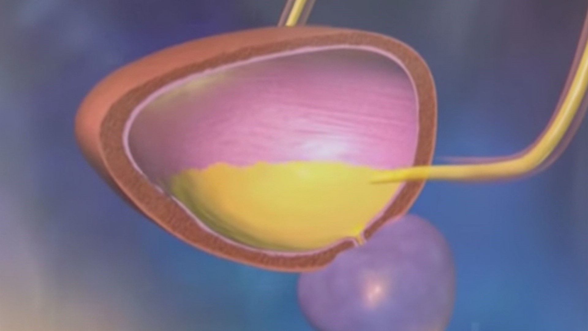 Breakthrough chemotherapy for rare urinary tract cancer | wqad.com