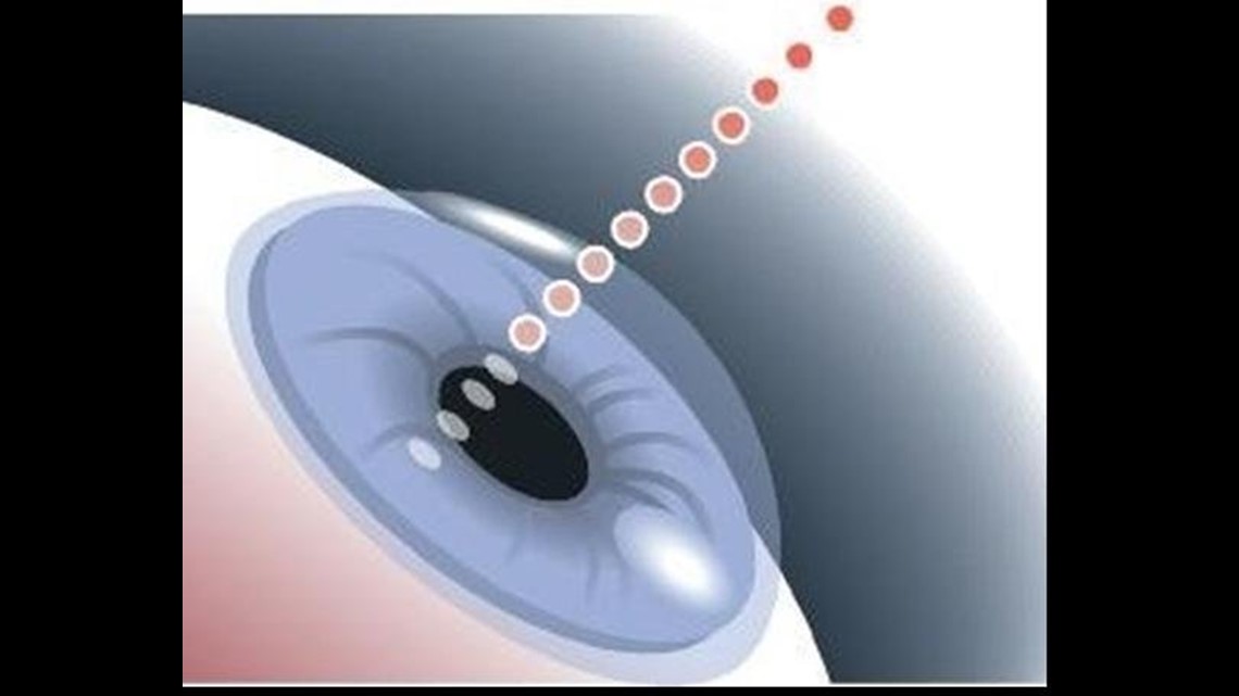 Laser Refractive Surgery | wqad.com