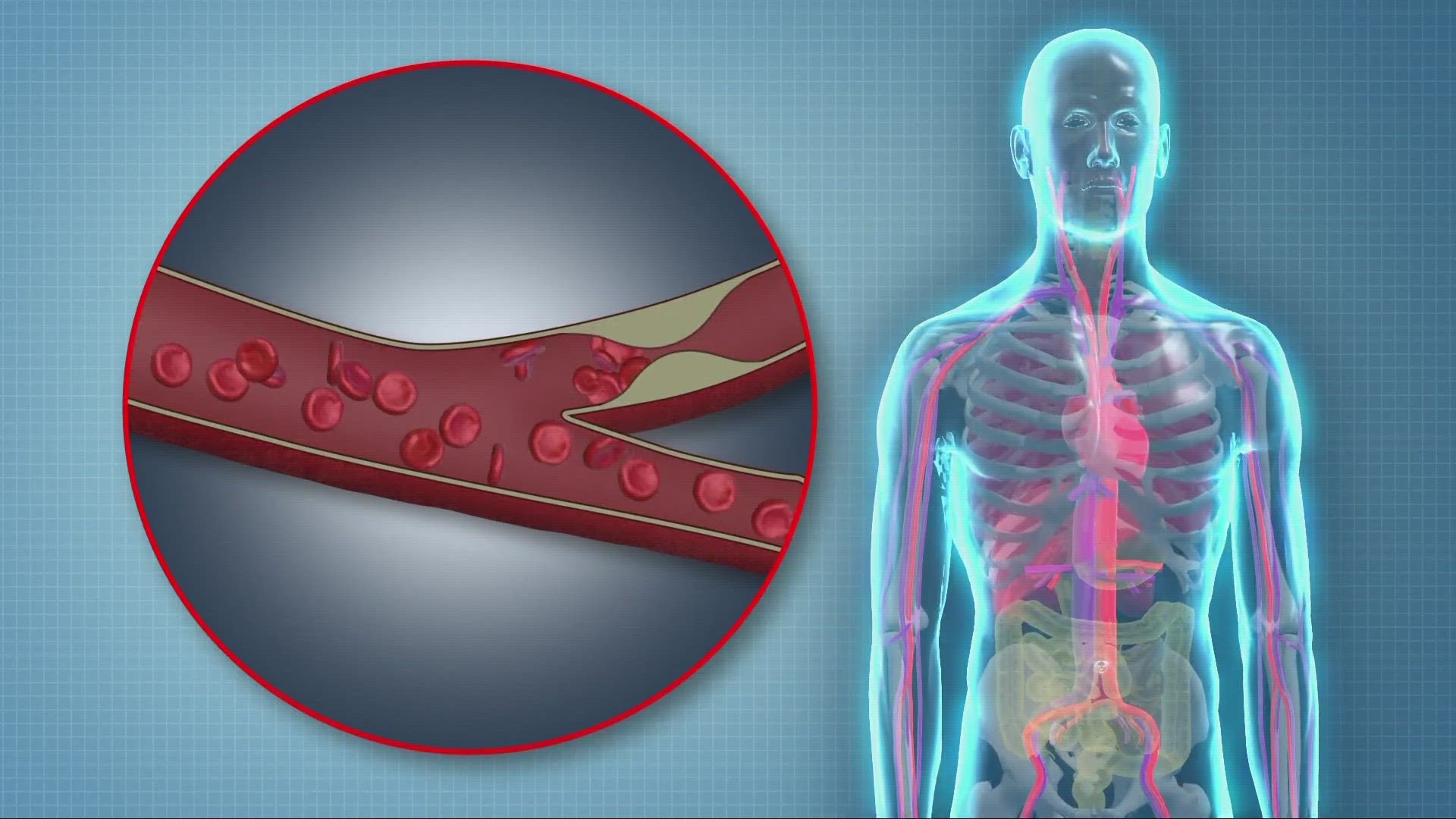 CDC research shows untreated cholesterol levels create severe health ...