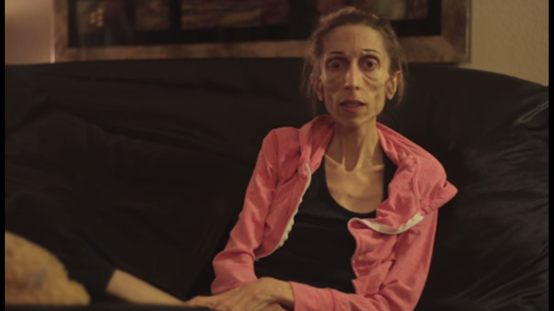 Woman Battling Anorexia Receives Help After Plea On Social Media