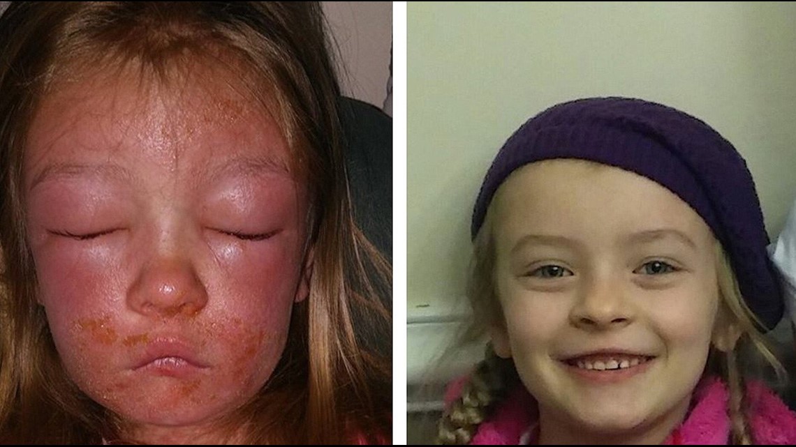 6-year-old develops bacterial skin infection after swimming at beach ...