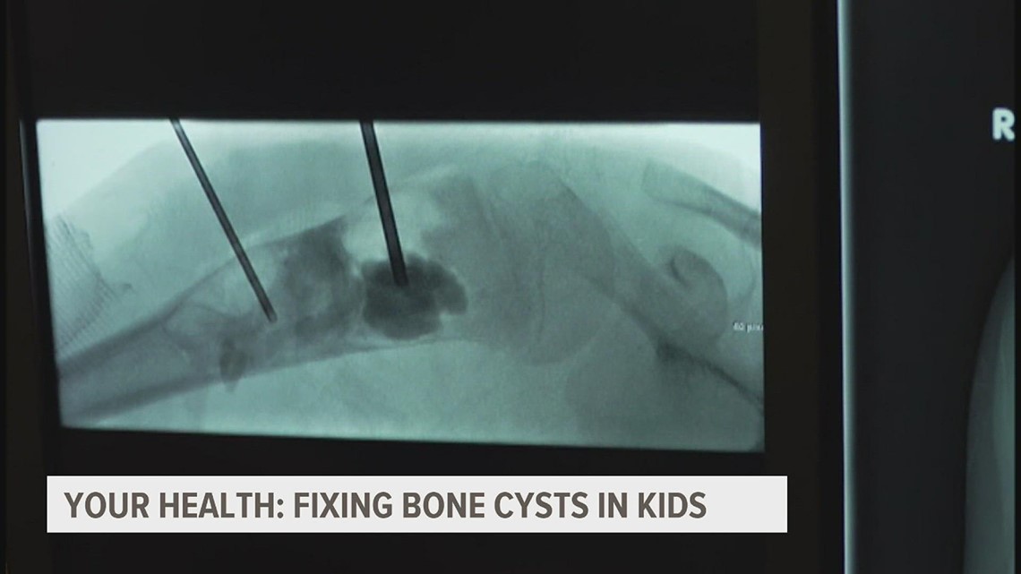 Your Health: Strengthening bones in kids with unicameral bone cysts ...
