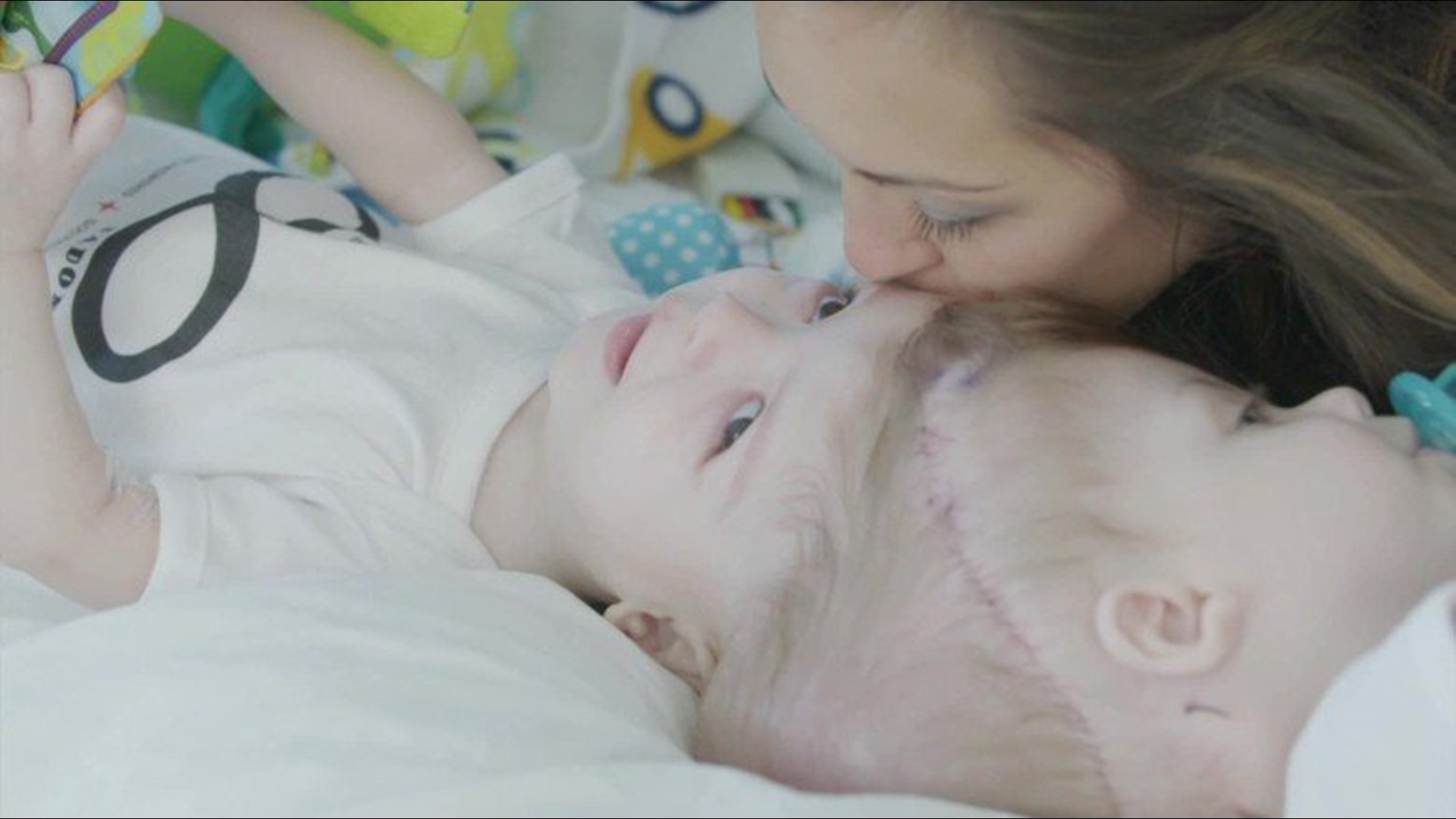 The McDonald Twins: Rare surgery to separate brothers conjoined at head ...