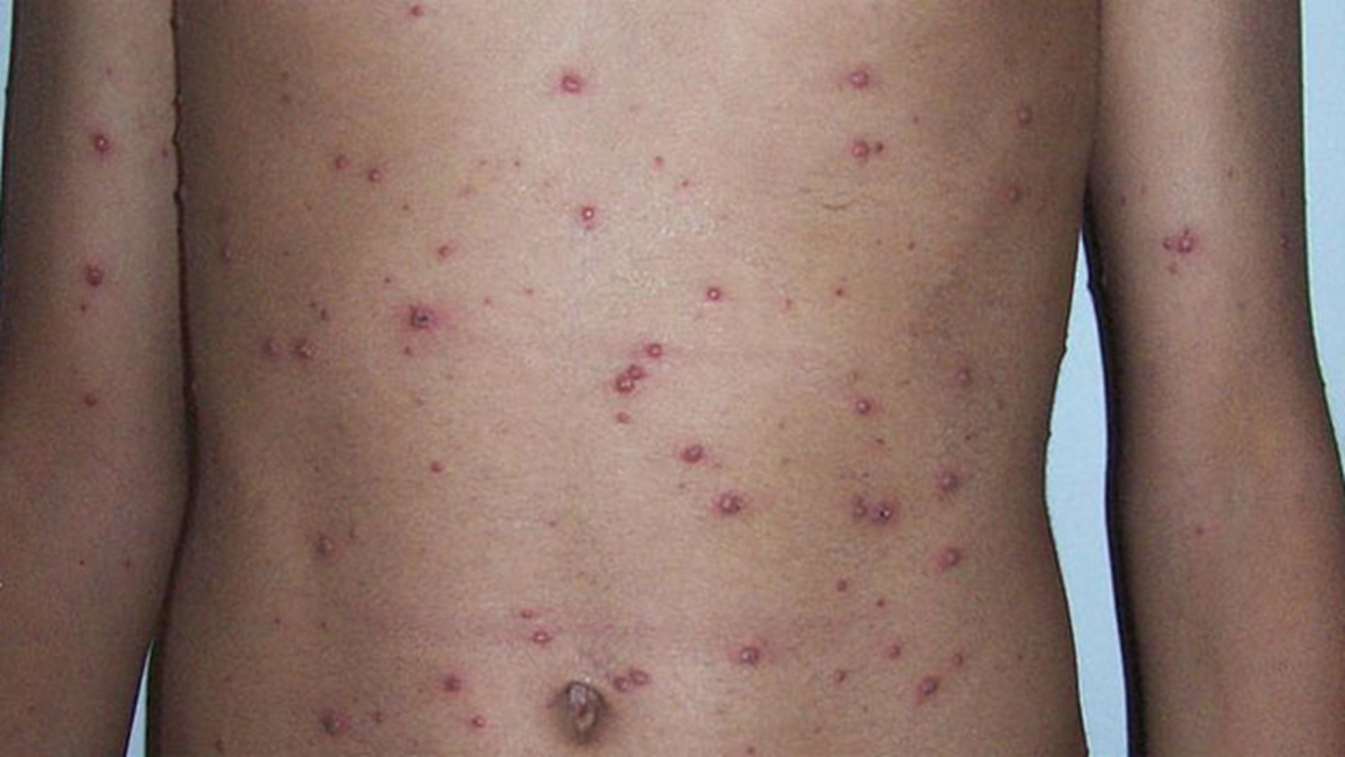 Chickenpox cases reported at Carmel-Clay Schools | wthr.com