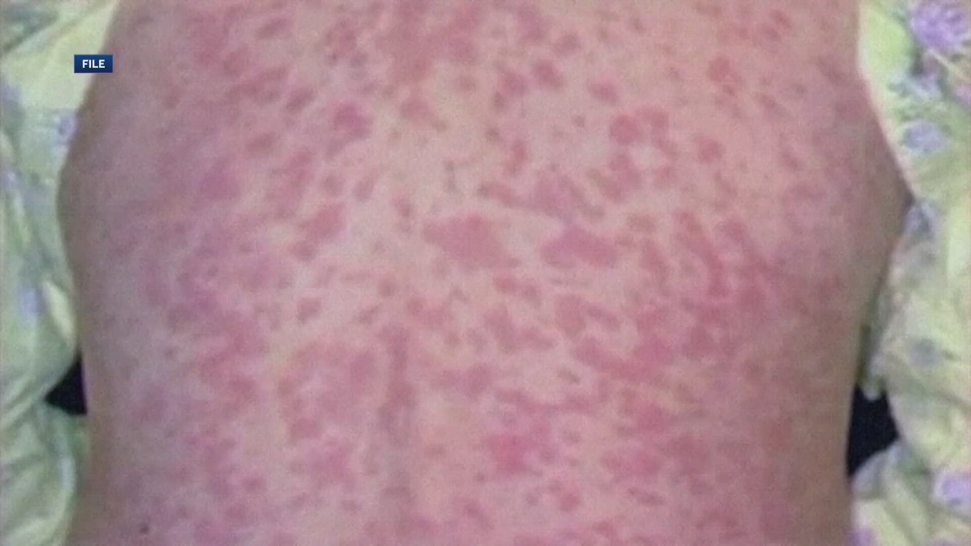 South Carolina confirms 124 new measles cases as outbreak on the ...