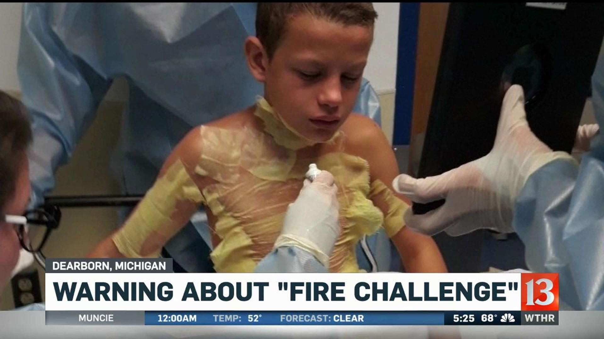 Fire challenge leaves 12-year-old boy with severe burns after friend ...