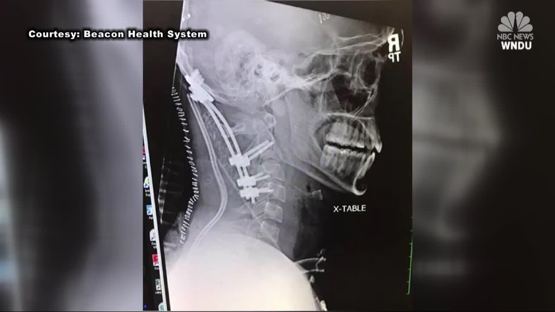 Indiana man survives internal decapitation | wthr.com