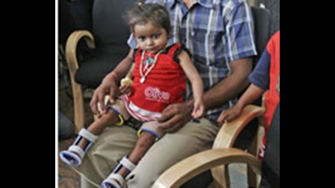 Girl born with 8 limbs leaves hospital | wthr.com