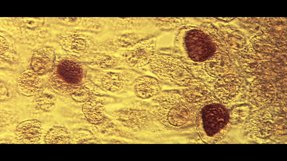 3 sexually transmitted diseases hit new highs again in US | wthr.com