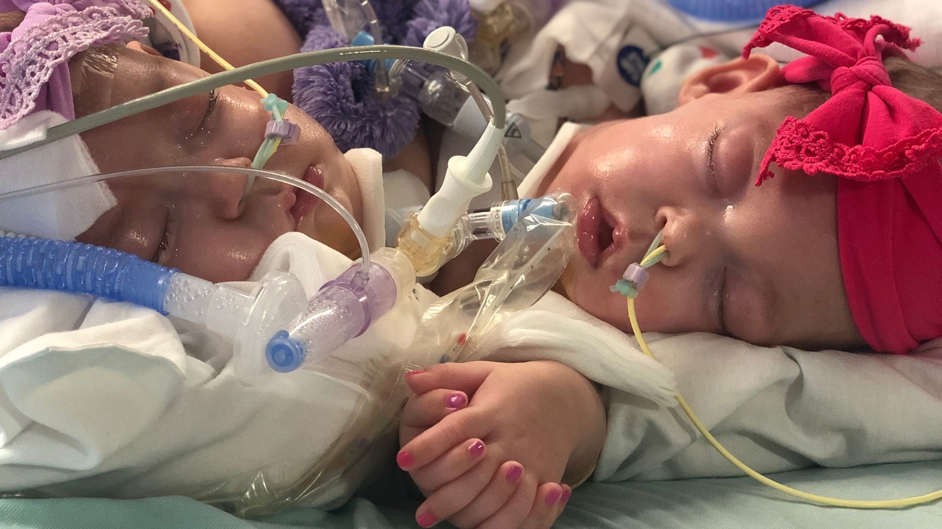 IU grad leads surgery to separate conjoined twins | wthr.com