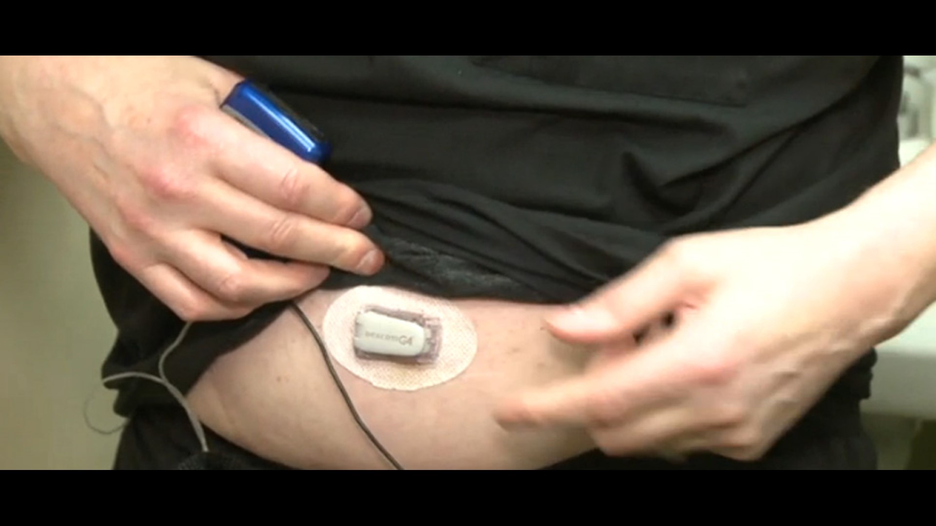 "Artificial pancreas" could be life-changer for many diabetics | wthr.com