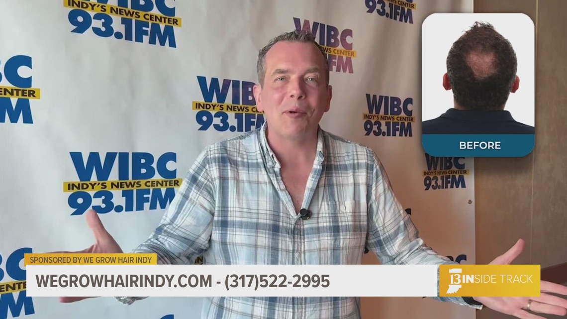 Indianapolis radio personality Jason Hammer to undergo hair restoration ...